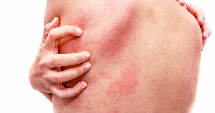 Netelroos (galbulten): oorzaak